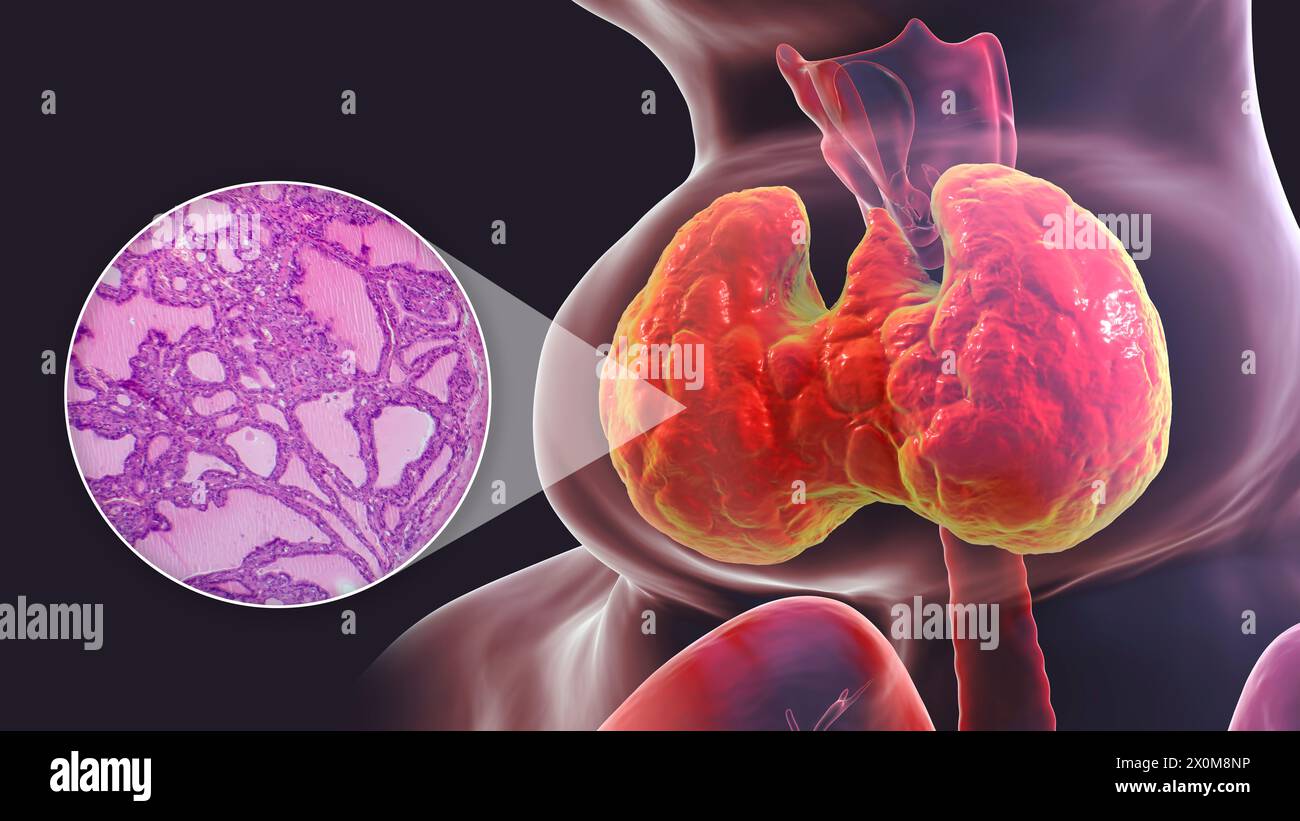3D illustration of a person with a toxic goitre (enlarged thyroid gland ...
