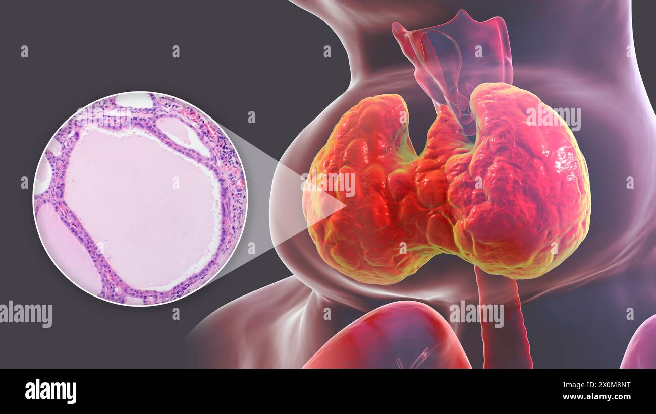 3D illustration of a person with an endemic goitre (enlarged thyroid ...