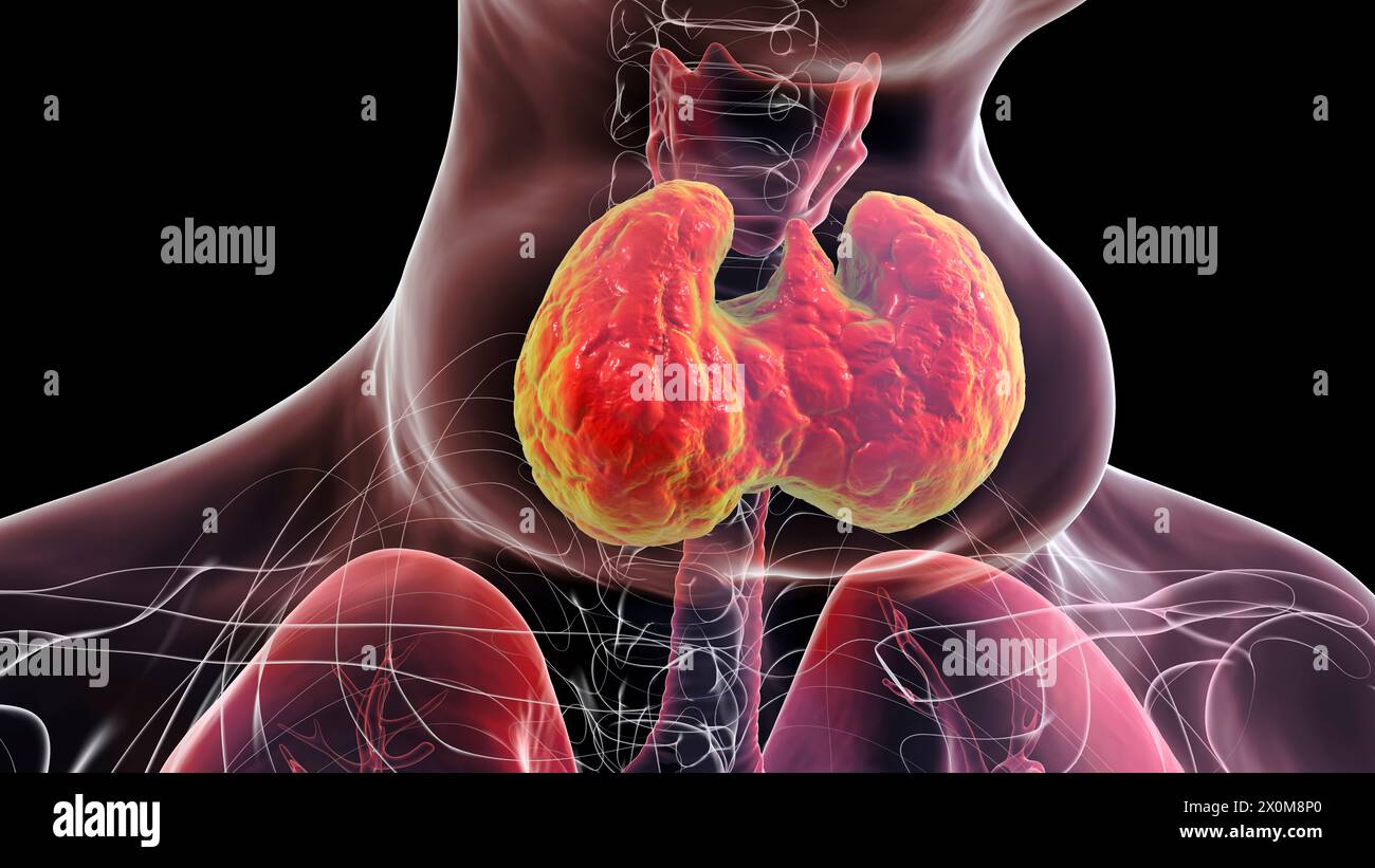 3D illustration of a woman with an enlarged thyroid gland, known as a ...