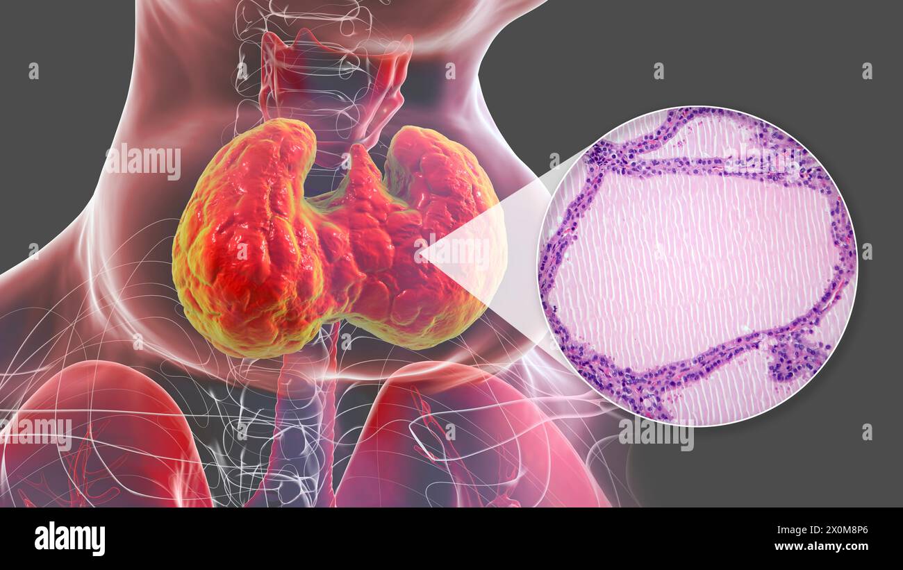 3D illustration of a person with an endemic goitre (enlarged thyroid ...
