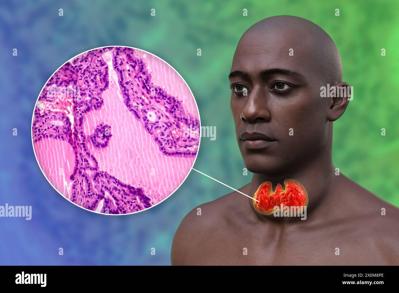3d Illustration Of A Man With A Toxic Goitre Enlarged Thyroid Gland Base Of Neck And A Close