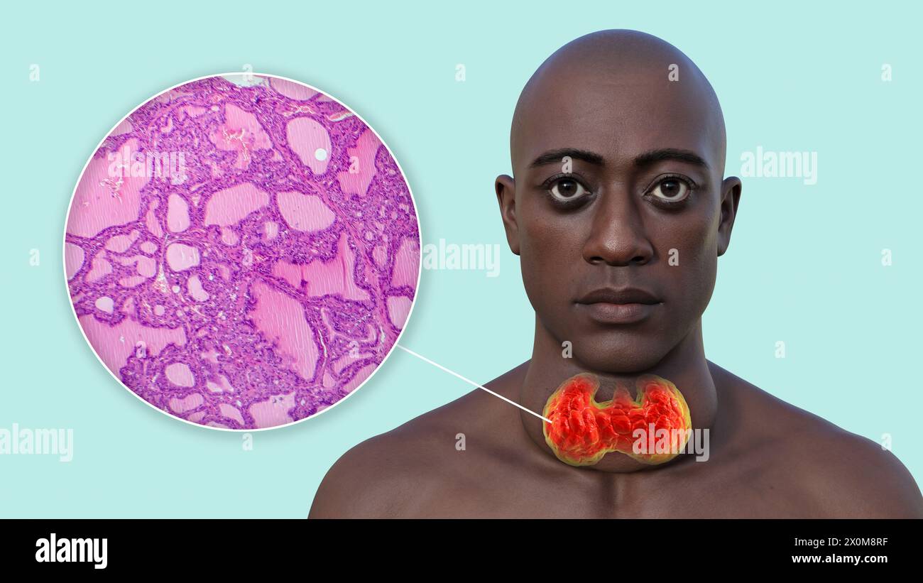 Thymus gland hi-res stock photography and images - Alamy