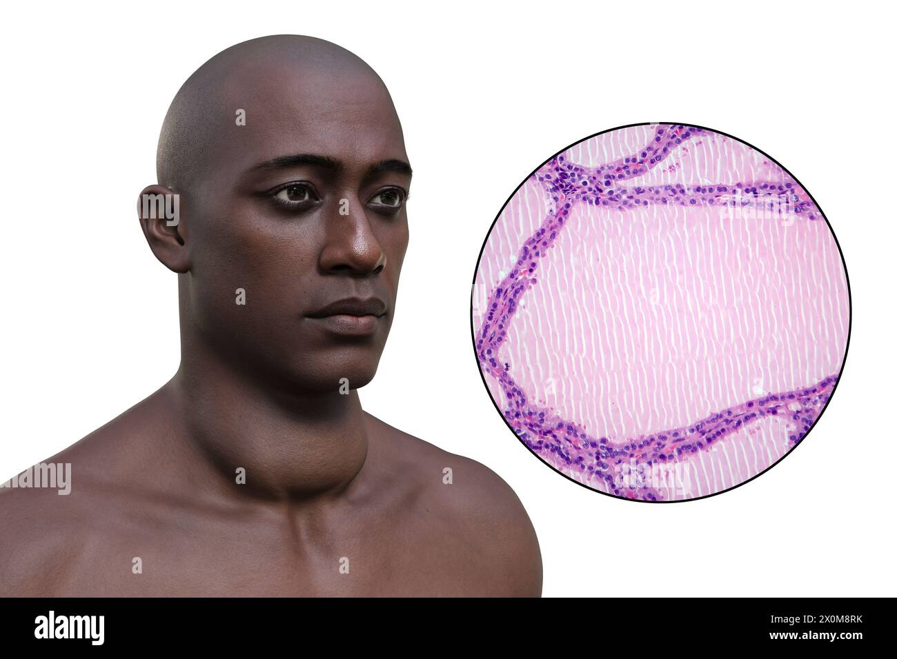 3D illustration of a man with an endemic goitre, and a close-up of the ...