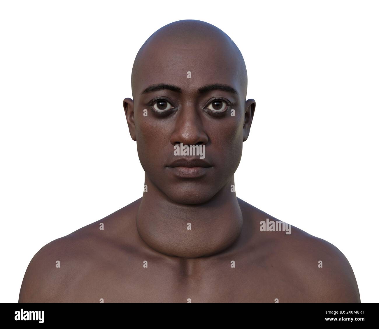 3D illustration of a man with an enlarged thyroid gland (goitre, base ...