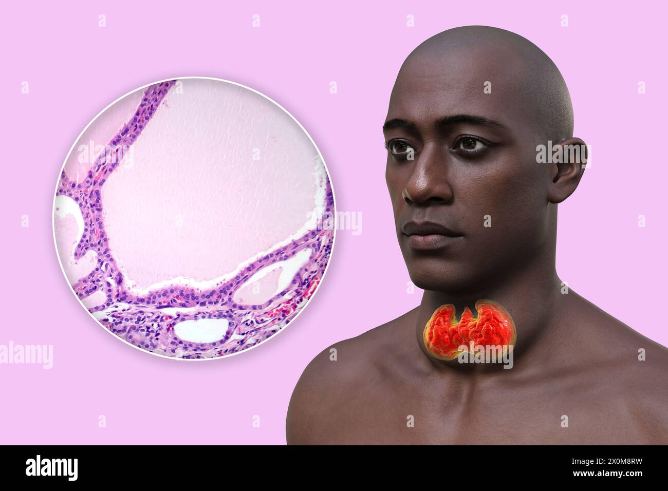 3D illustration of a man with an endemic goitre, and a close-up of the ...