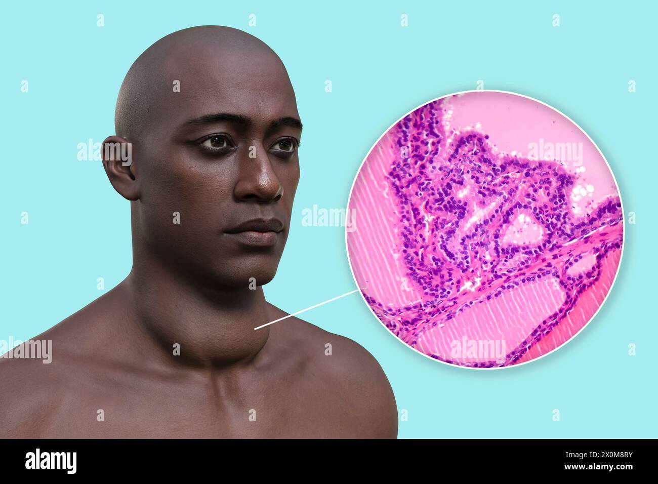 3d Illustration Of A Man With A Toxic Goitre Enlarged Thyroid Gland Base Of Neck And A Close