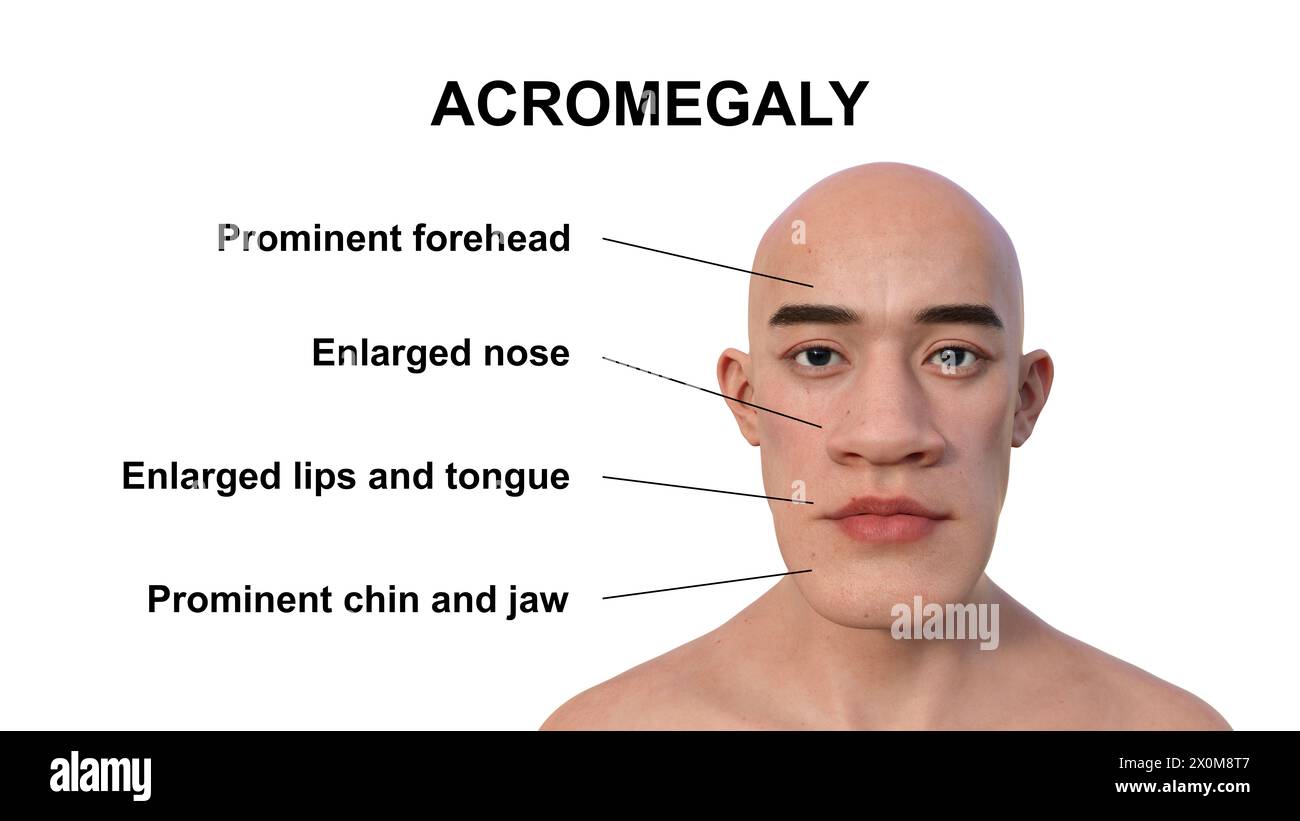 3D illustration of a man with acromegaly. This is a condition causing ...