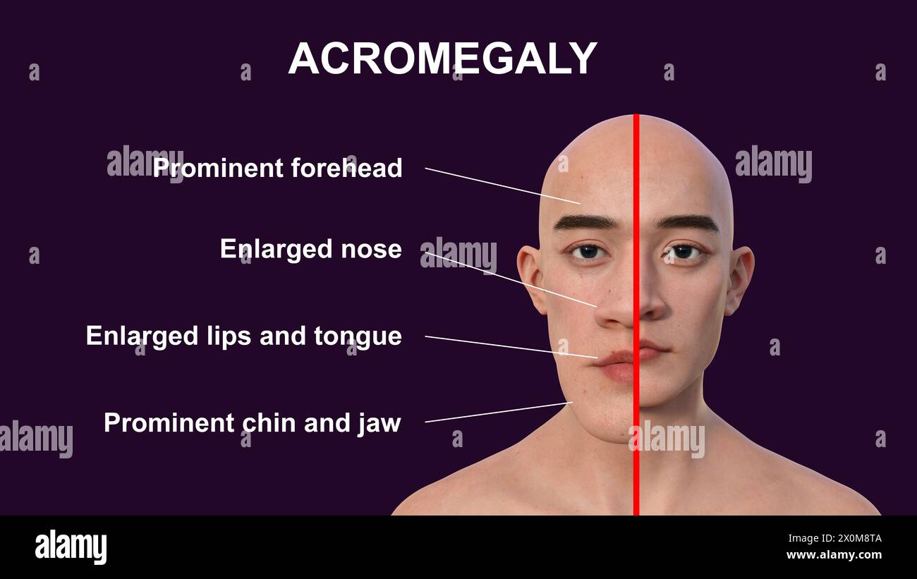 Aisteoir Acromegaly BEATHAISNÉIS GREAT KHALI FÍRICÍ, ÓIGE, SAOL