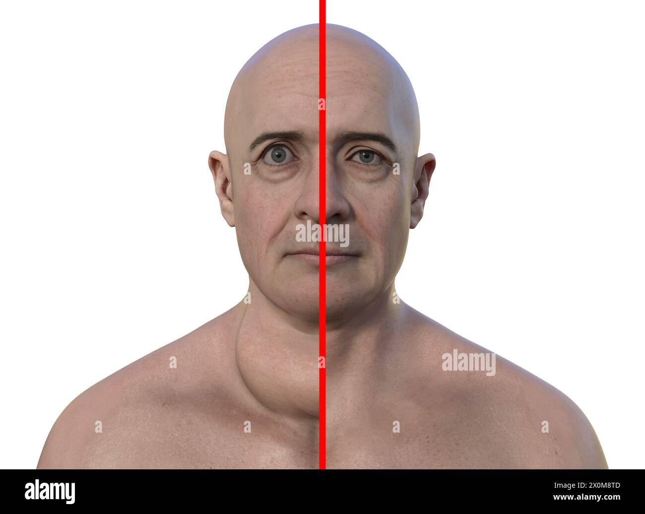 3D illustration of a man with an enlarged thyroid gland (goitre, base ...