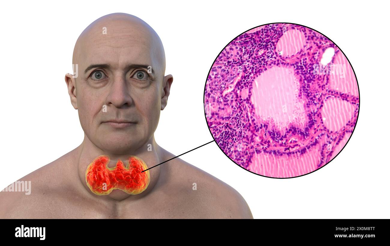 3D illustration of a man with a toxic goitre (enlarged thyroid gland ...