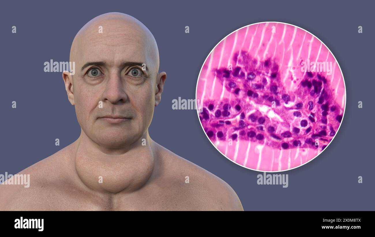 3D illustration of a man with a toxic goitre (enlarged thyroid gland ...