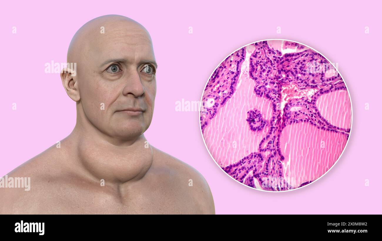 3d Illustration Of A Man With A Toxic Goitre Enlarged Thyroid Gland Base Of Neck And A Close