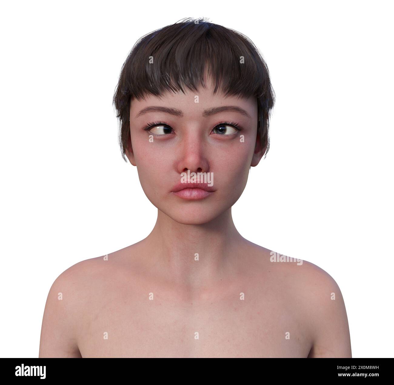 Illustration of a woman with esotropia showing inward eye misalignment ...