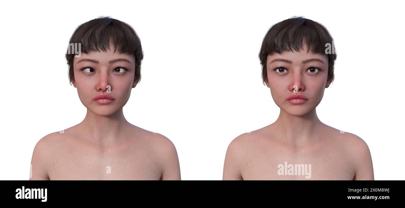 Illustration of a woman with esotropia showing inward eye misalignment ...