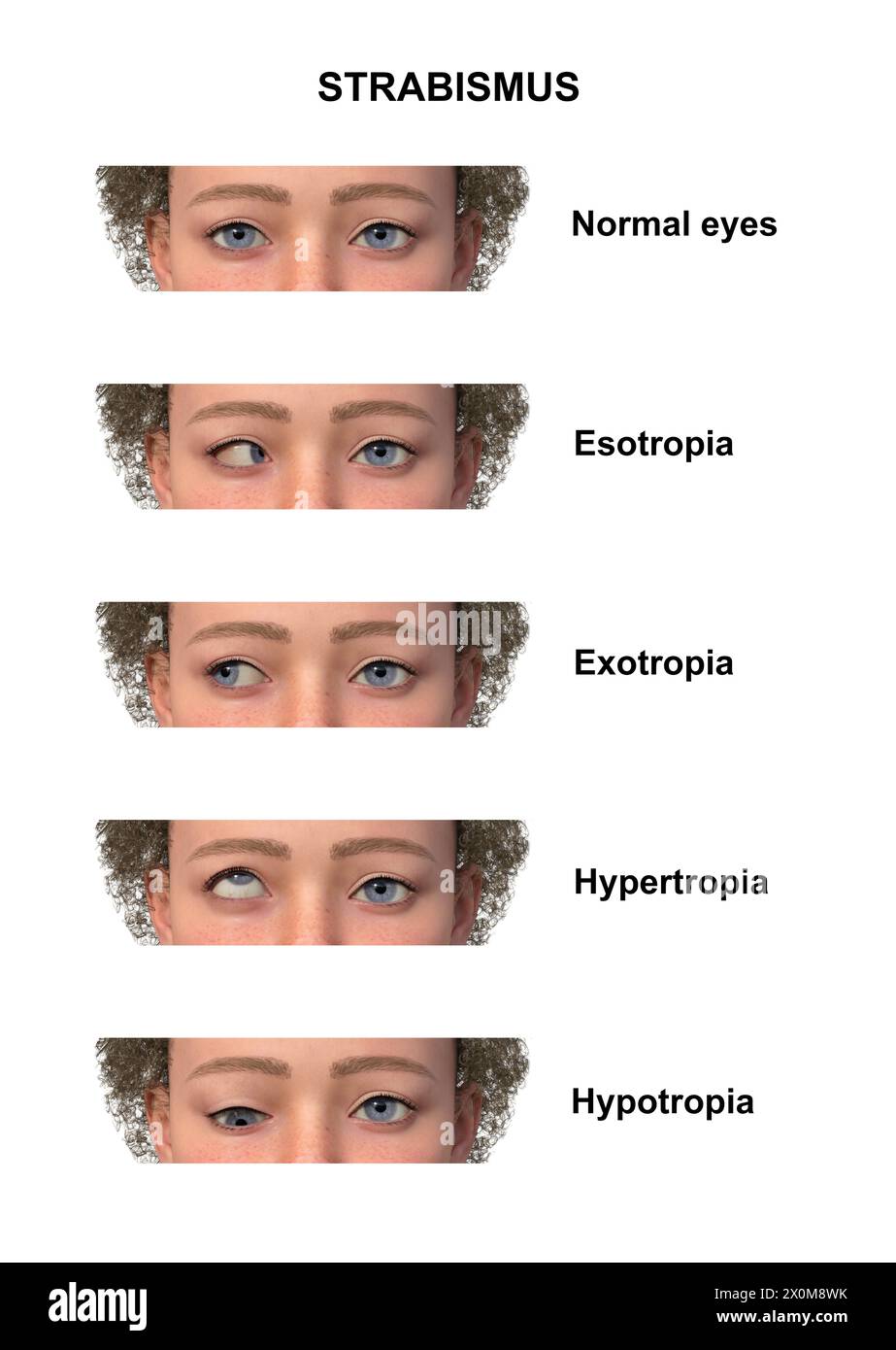 Illustration of a child with various strabismus types: esotropia ...