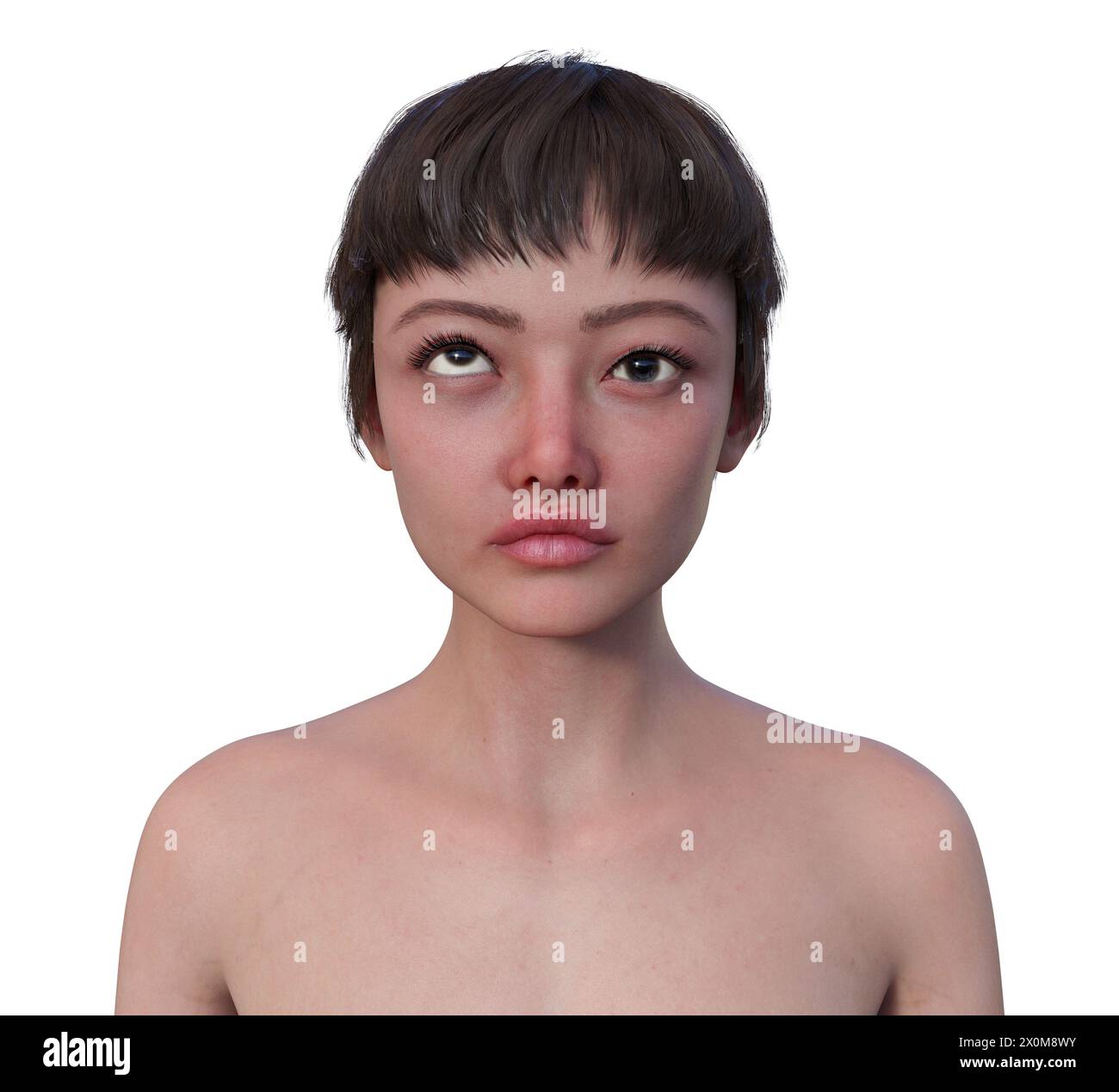 Illustration of a woman with hypotropia displaying upward eye ...