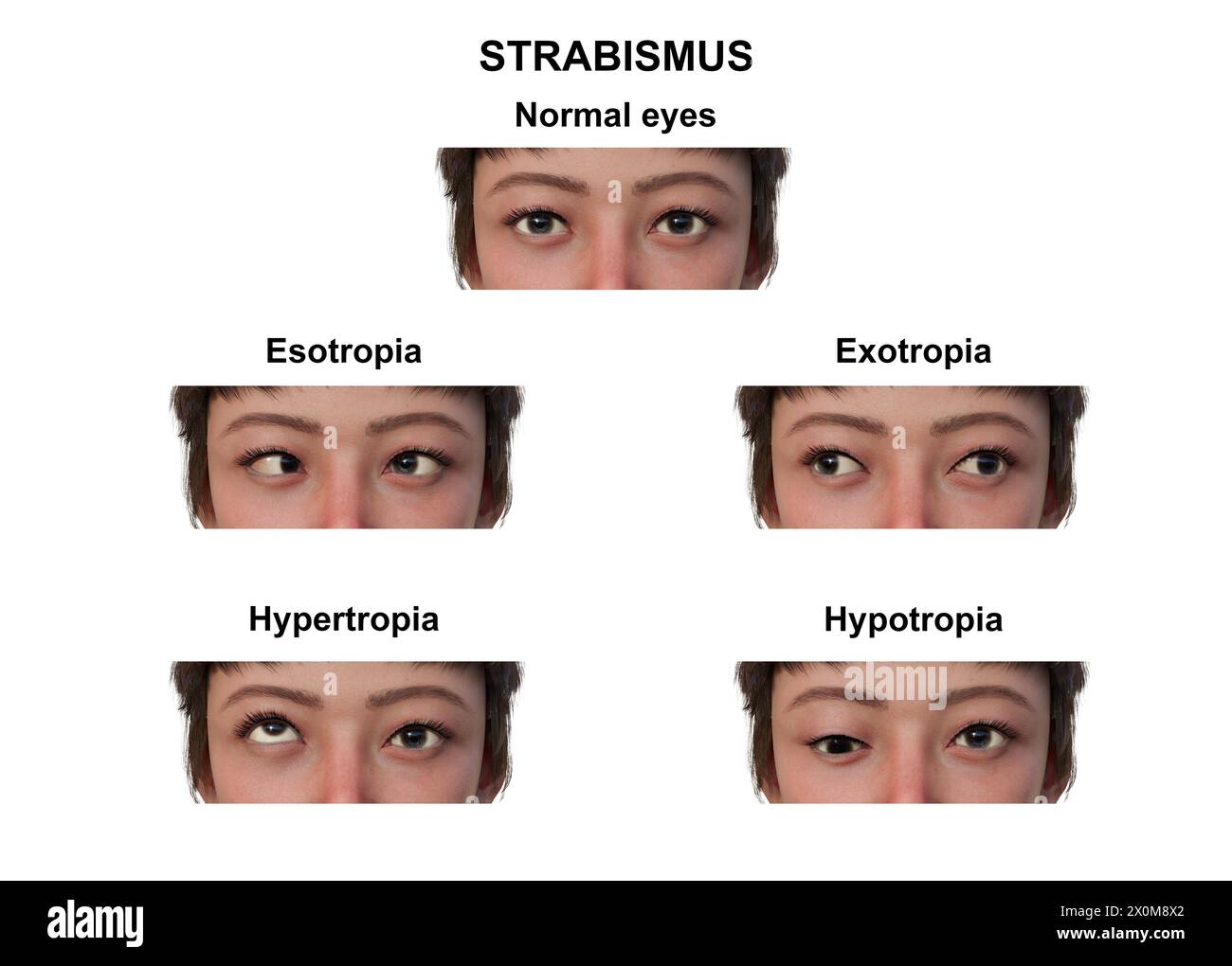 Illustration of a woman with various strabismus types: esotropia ...