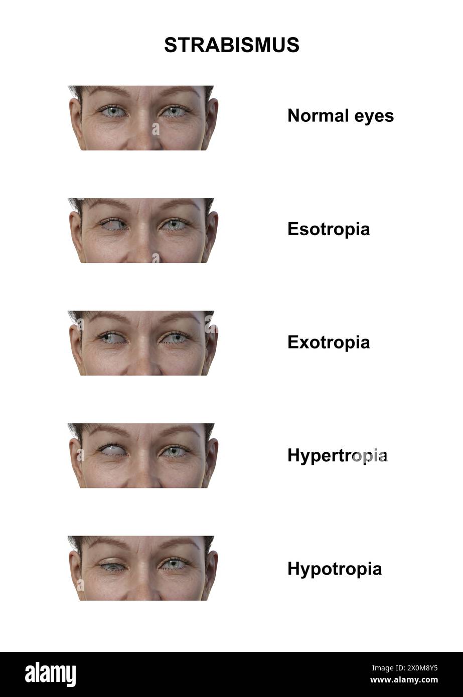 Illustration of a woman with various strabismus types: esotropia ...