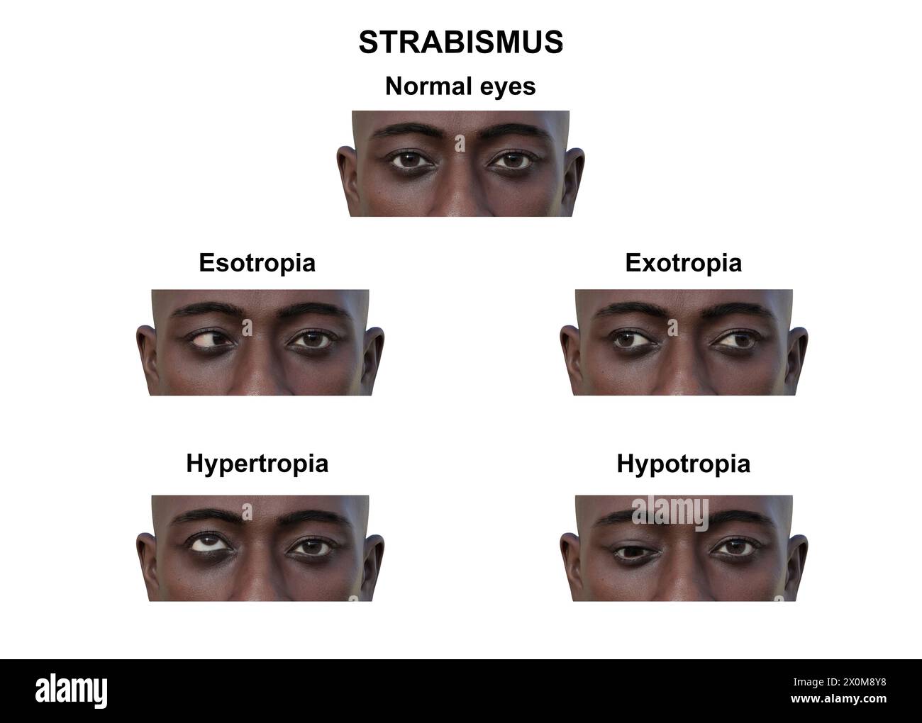 Illustration of a man with various strabismus types: esotropia ...
