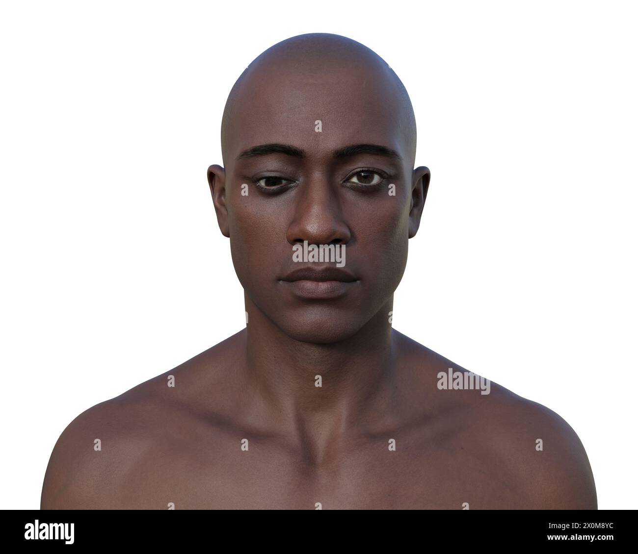 Illustration of a man with hypotropia featuring downward eye ...
