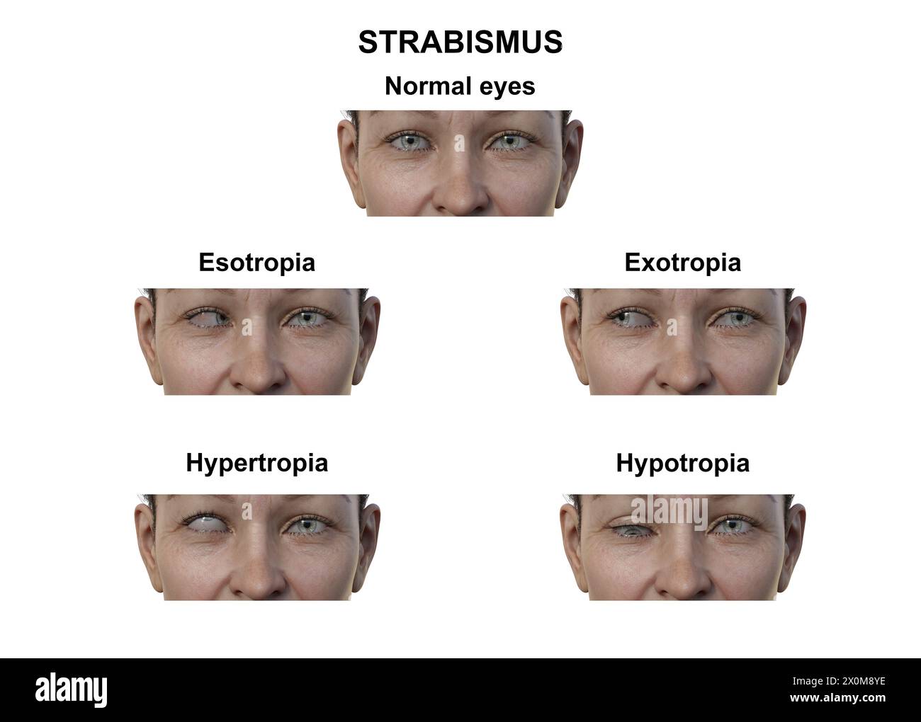 Illustration of a woman with various strabismus types: esotropia ...