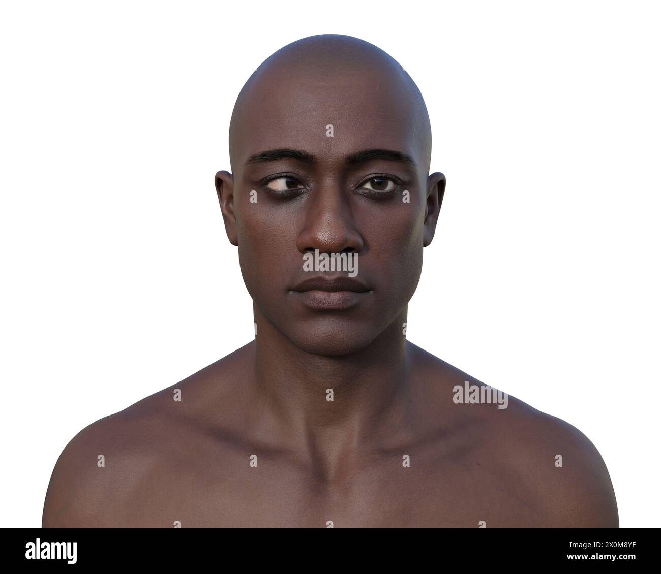 Illustration of a man with esotropia showing inward eye misalignment ...
