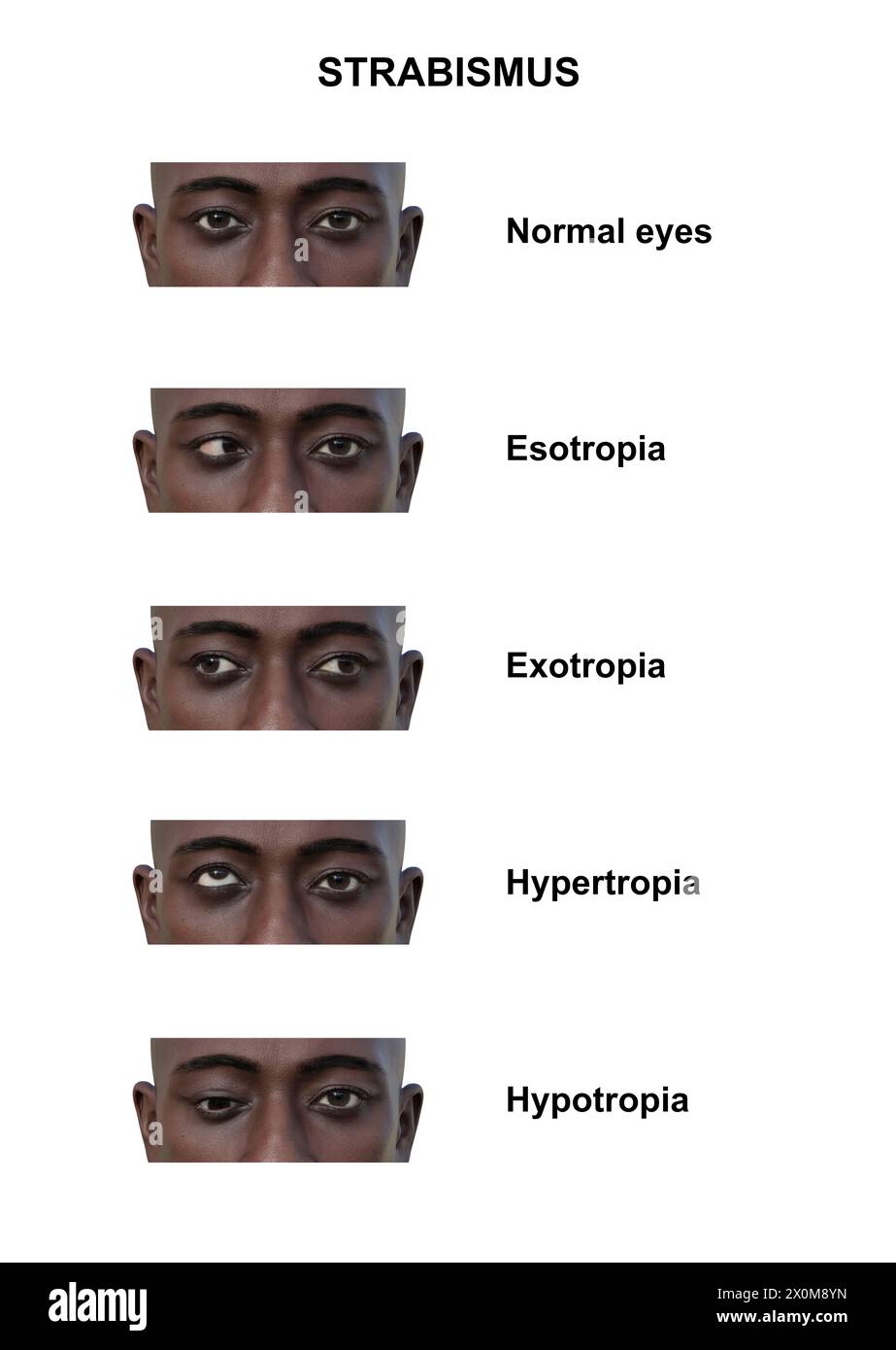 Illustration of a man with various strabismus types: esotropia ...