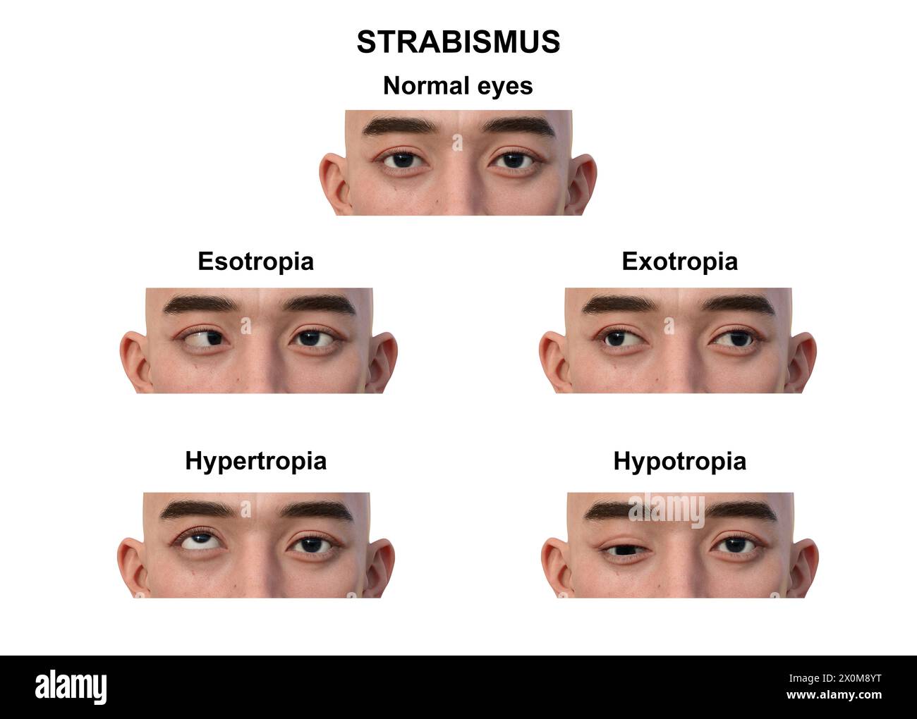 Strabismus hi-res stock photography and images - Alamy
