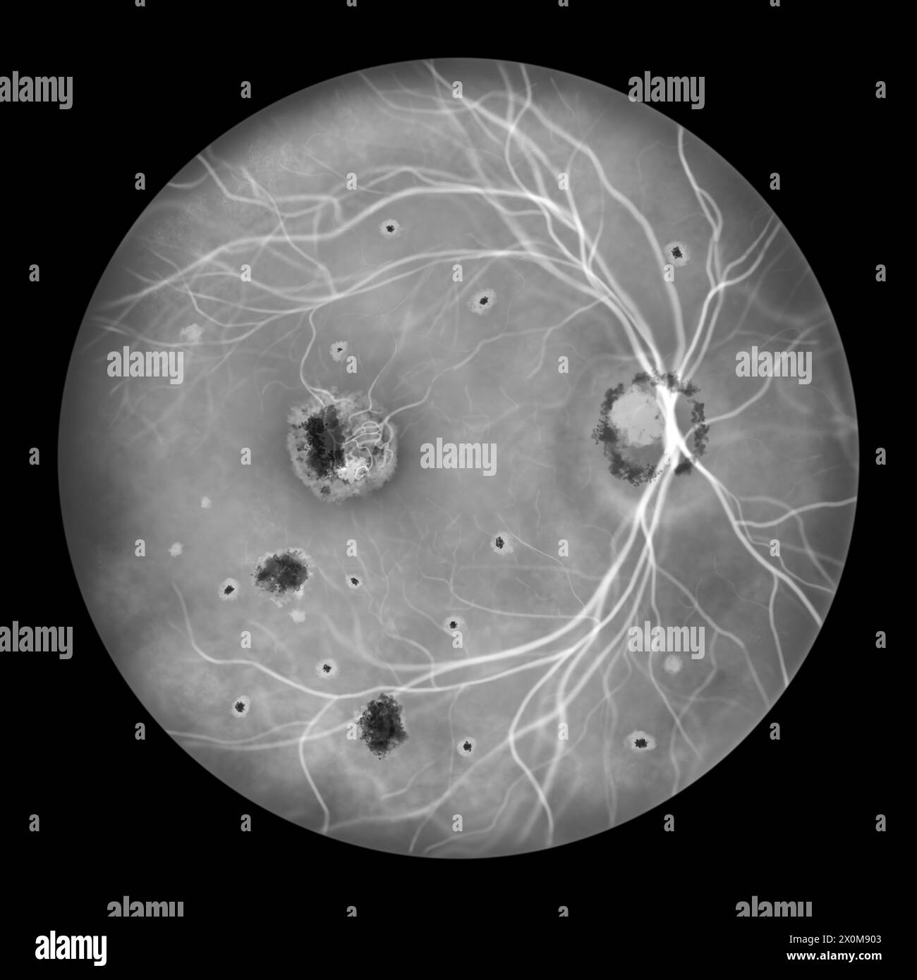 Eye Disease Histoplasmosis Astigmatism Glaucoma Swollen