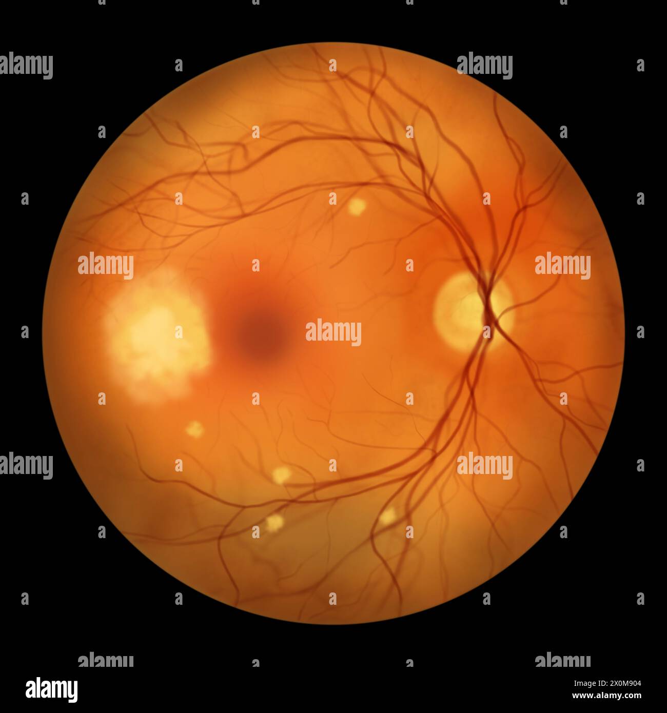 Illustration of a retina affected by blastomycosis as seen during ...