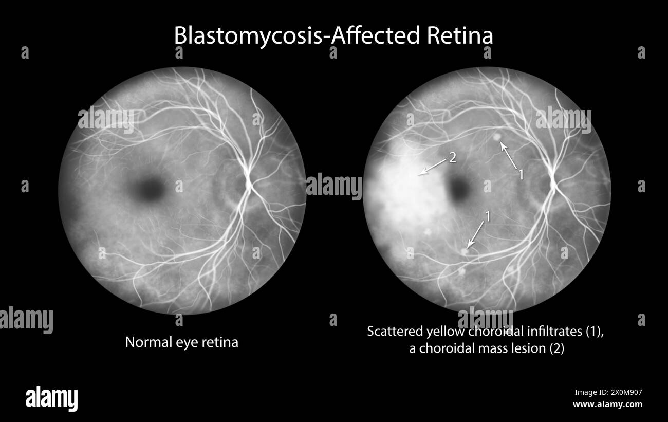 Illustration of a retina affected by blastomycosis as seen in ...