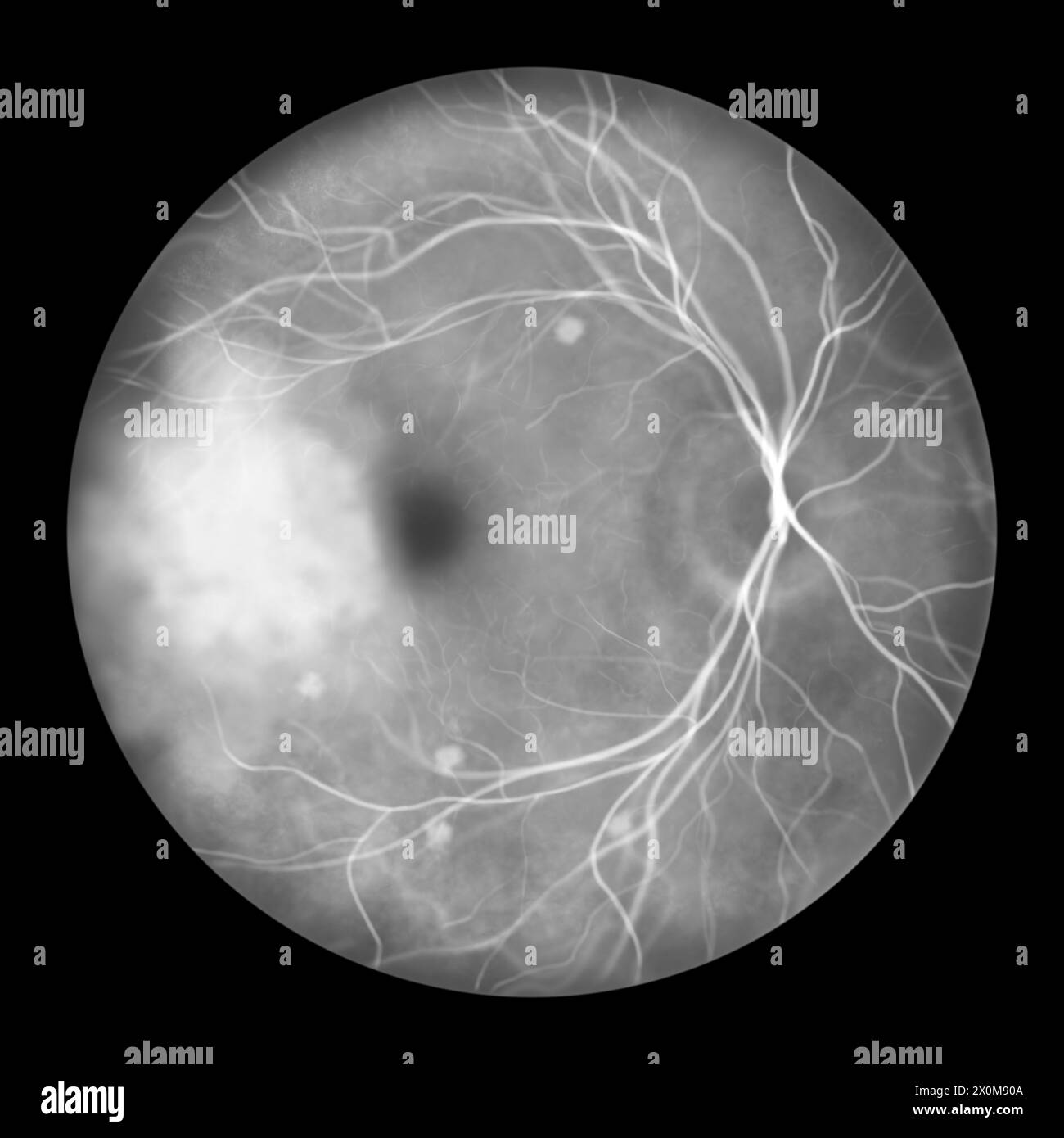 Illustration of a retina affected by blastomycosis as seen in ...