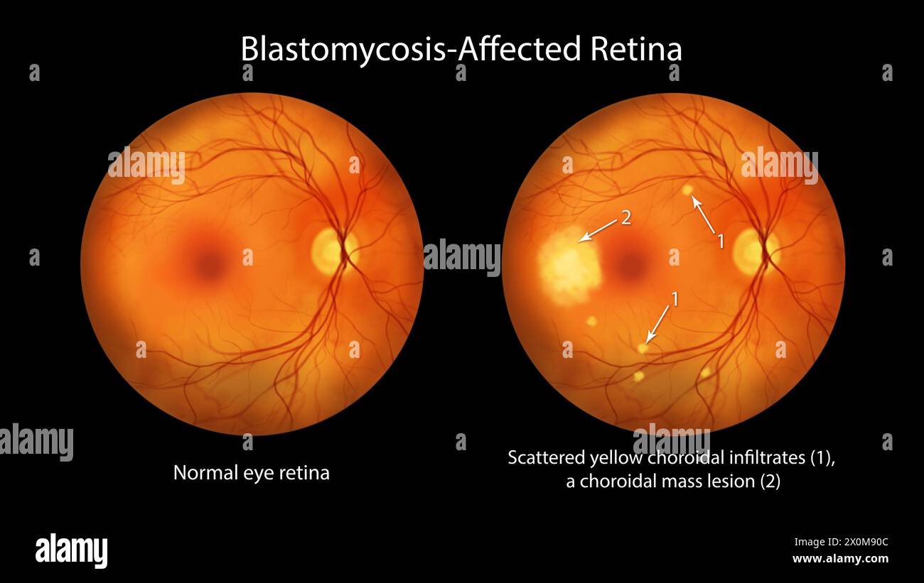Illustration of a retina affected by blastomycosis as seen in ...