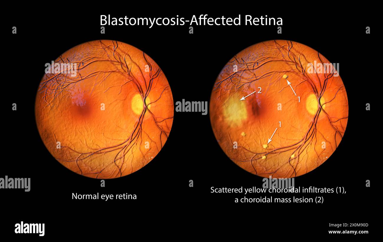 Illustration of a retina affected by blastomycosis as seen during ...