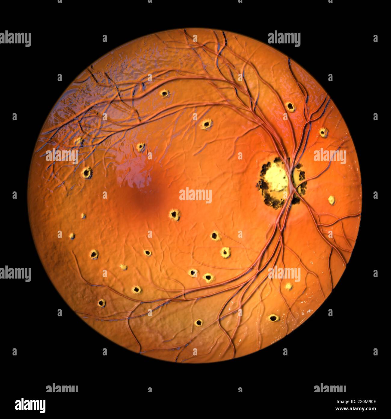 Illustration Of A Retina Affected By Presumed Ocular Histoplasmosis Syndrome As Seen In