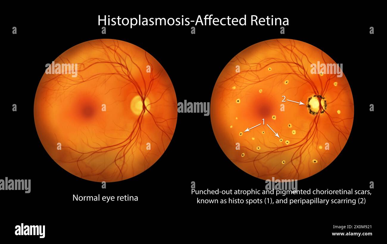 Illustration of a retina affected by presumed ocular histoplasmosis ...