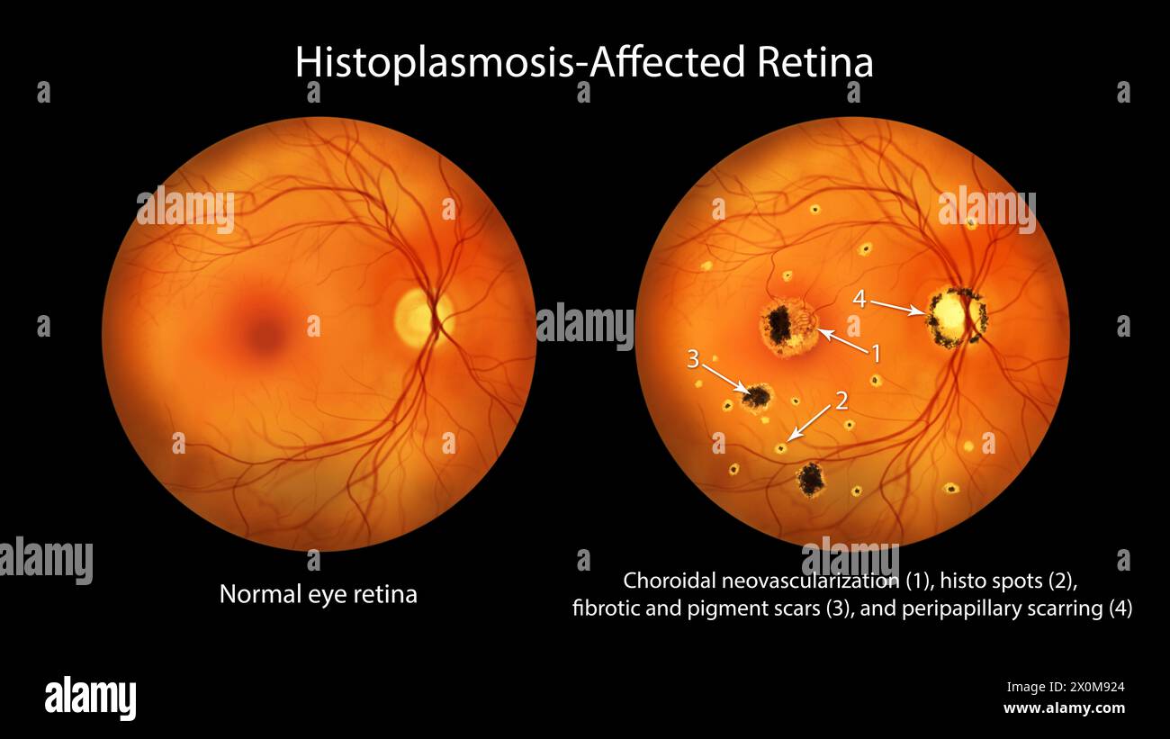 Illustration Of A Retina Affected By Presumed Ocular Histoplasmosis Syndrome As Seen In