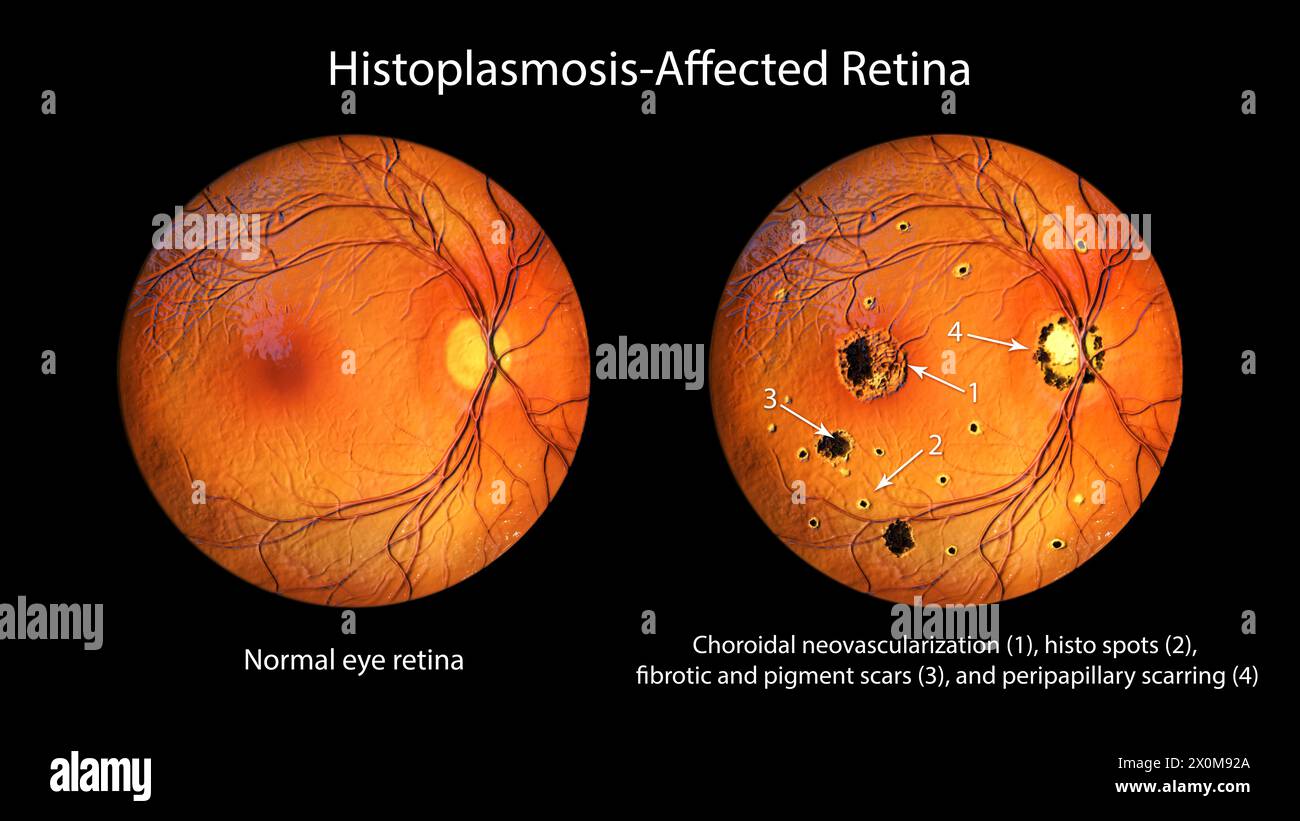 Ocular pathology hi-res stock photography and images - Alamy