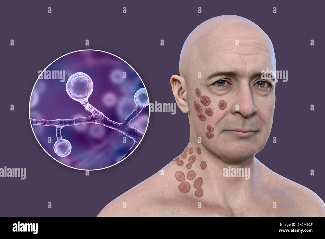3D illustration of a man with multiple face and neck lesions caused by ...