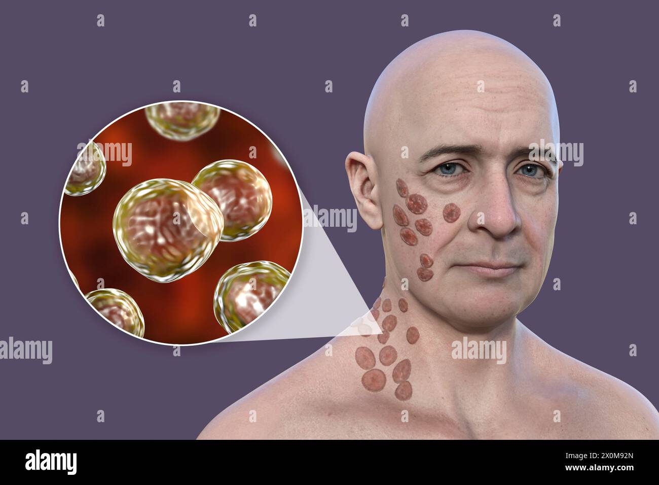 Blastomyces dermatitidis hi-res stock photography and images - Alamy