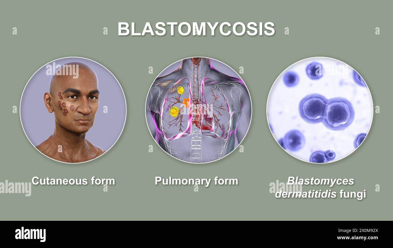 3D illustration showing two clinical presentations of blastomycosis and a close-up view of ...