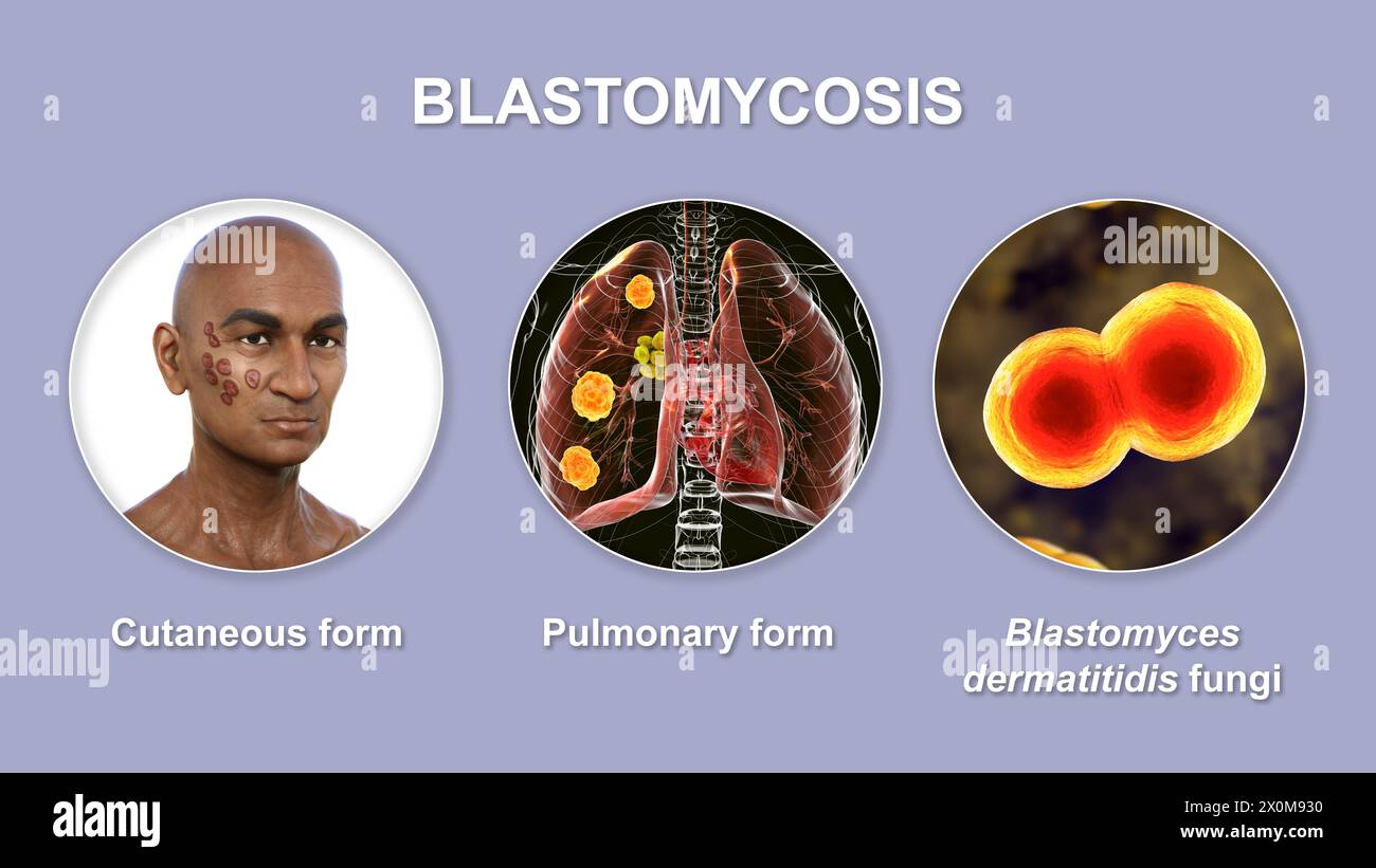 3D illustration showing two clinical presentations of blastomycosis and a close-up view of ...