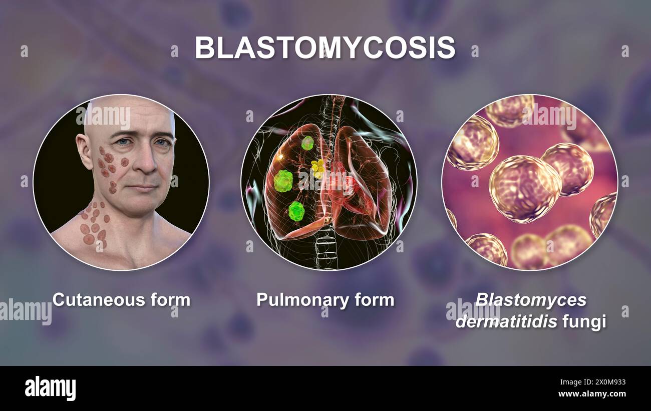 3D illustration showing two clinical presentations of blastomycosis and ...