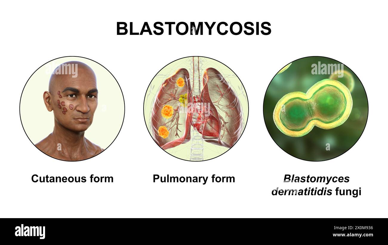 3D illustration showing two clinical presentations of blastomycosis and a close-up view of ...