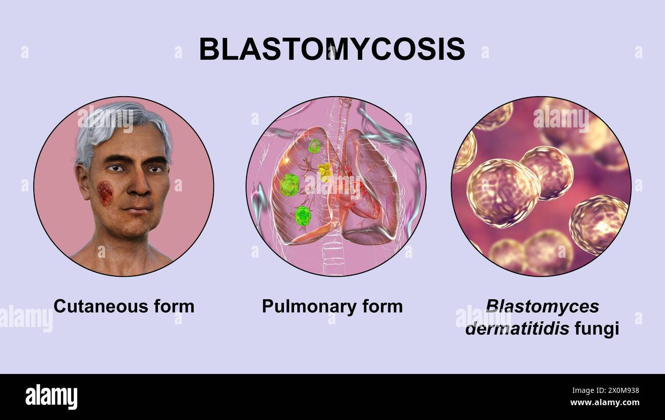 3D illustration showing two clinical presentations of blastomycosis and ...