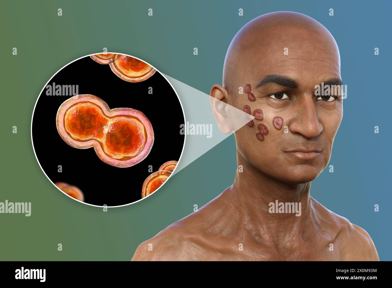 Blastomyces dermatitidis hi-res stock photography and images - Alamy