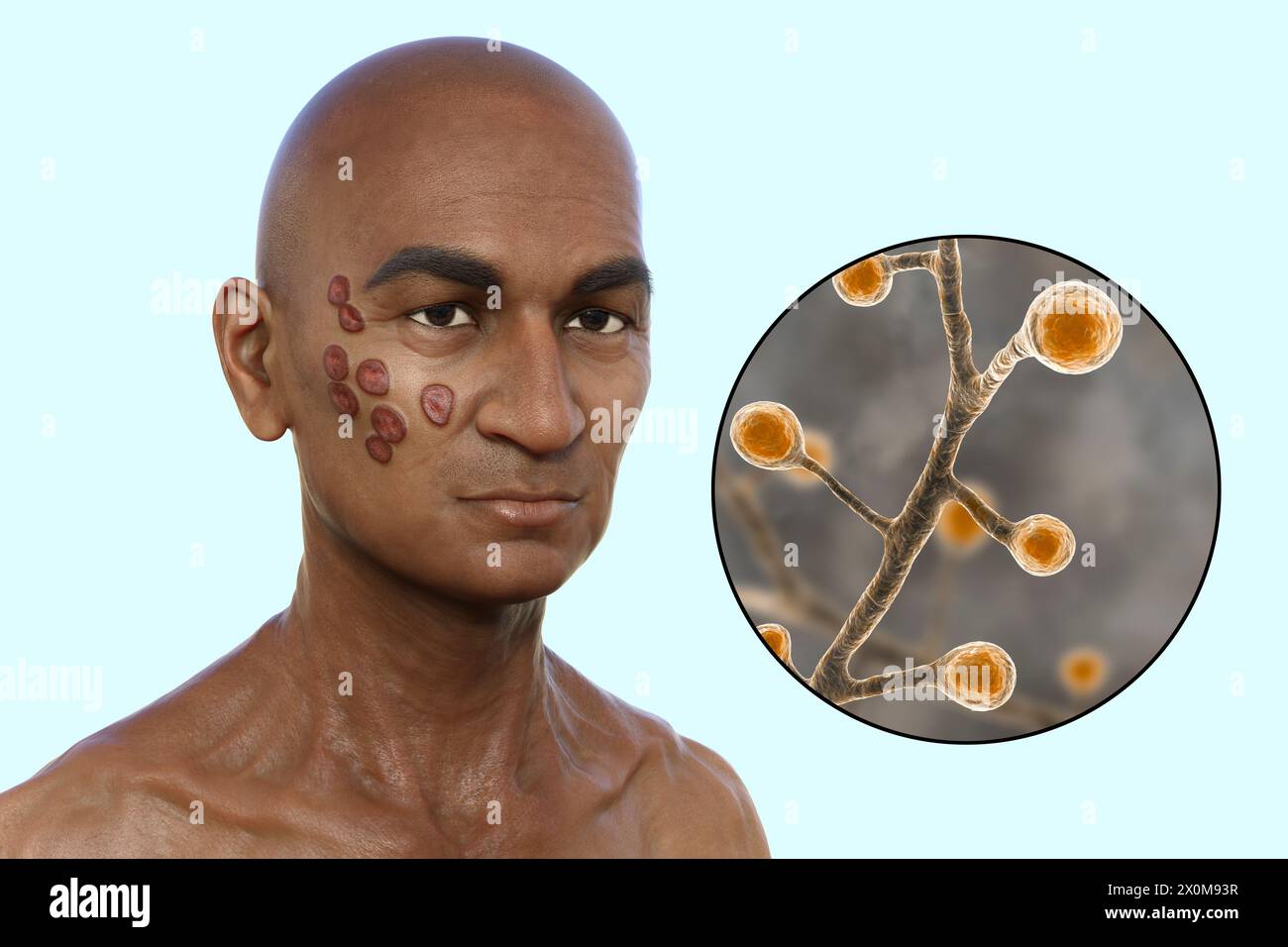 3D illustration of a man with multiple face and neck lesions caused by ...