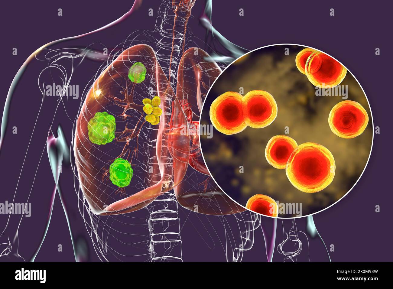 3D illustration of pulmonary blastomycosis, and a close-up of the ...