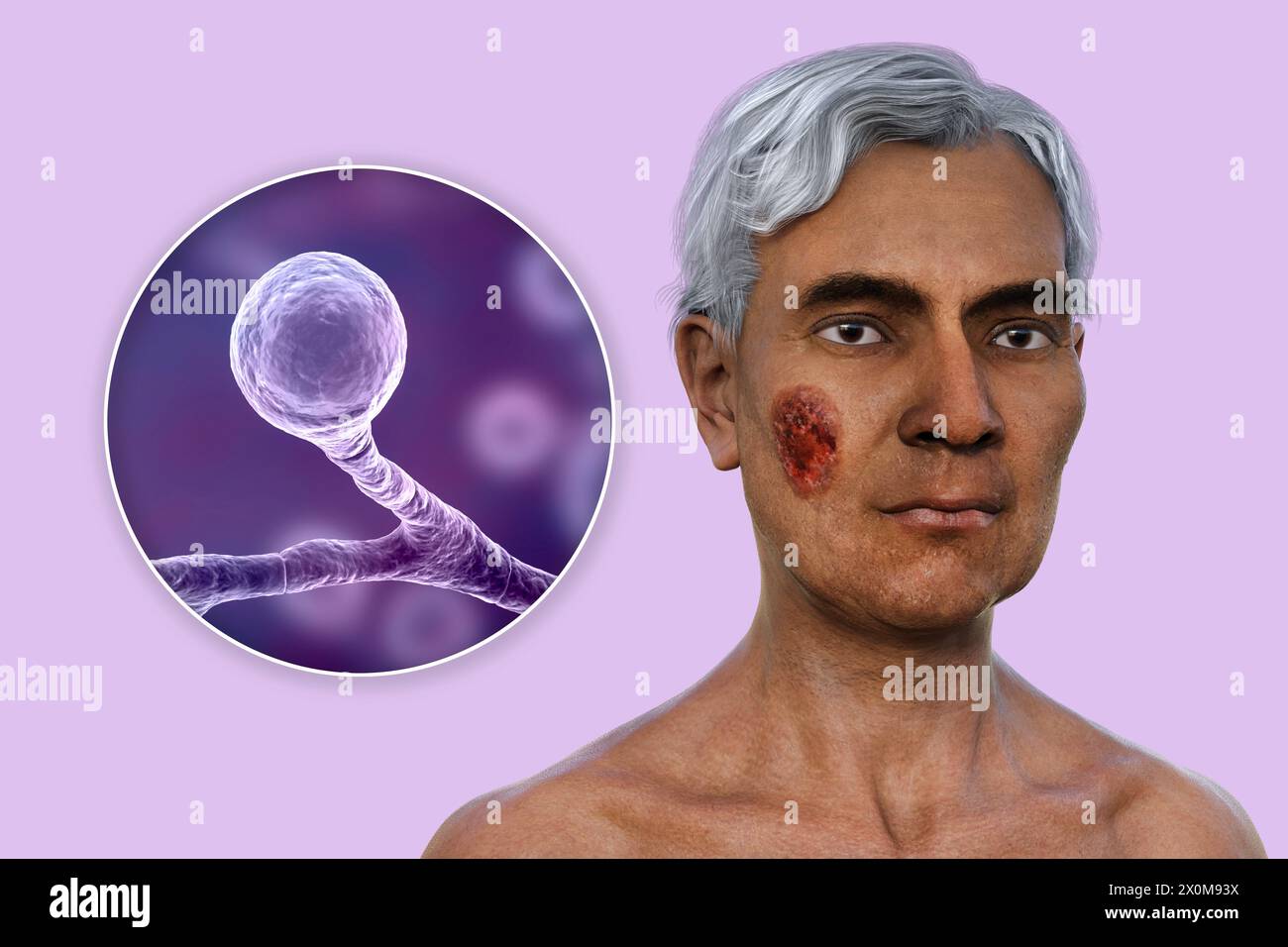 Blastomyces dermatitidis hi-res stock photography and images - Alamy