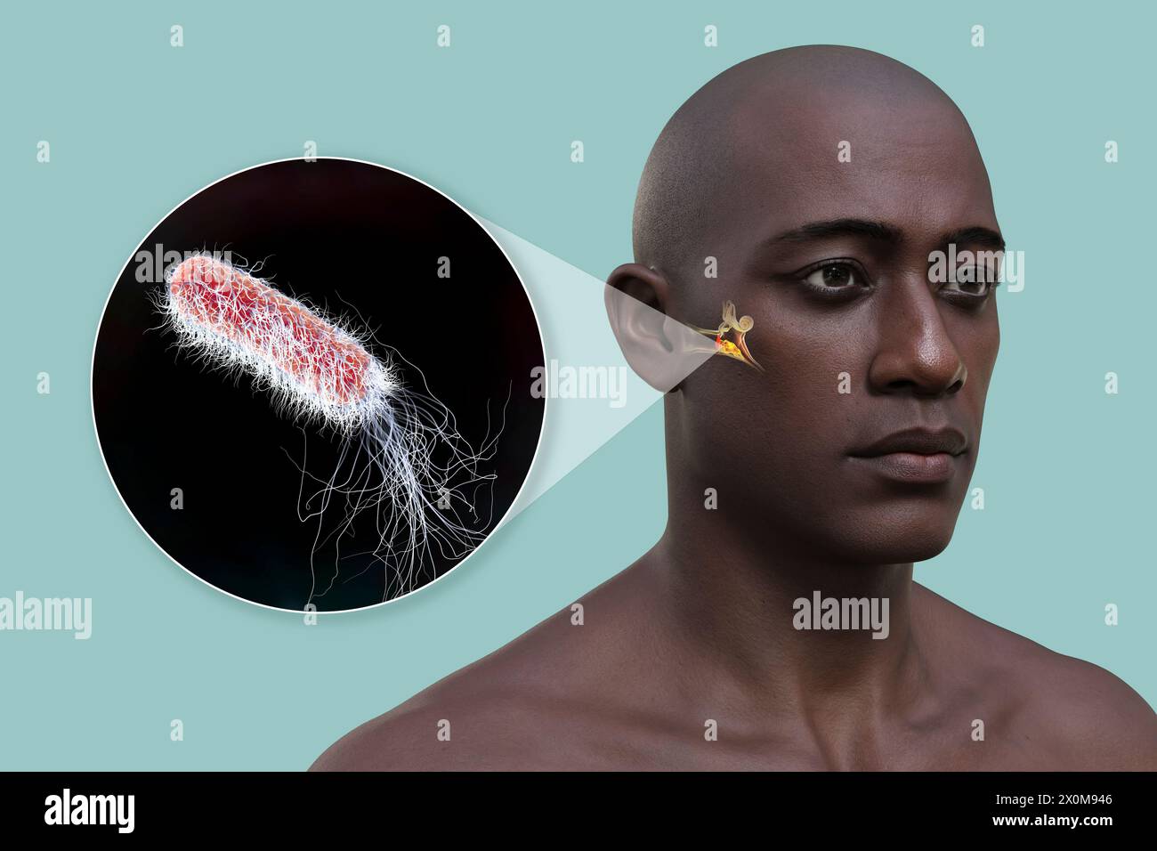 Pseudomonas Aeruginosa Skin Infection